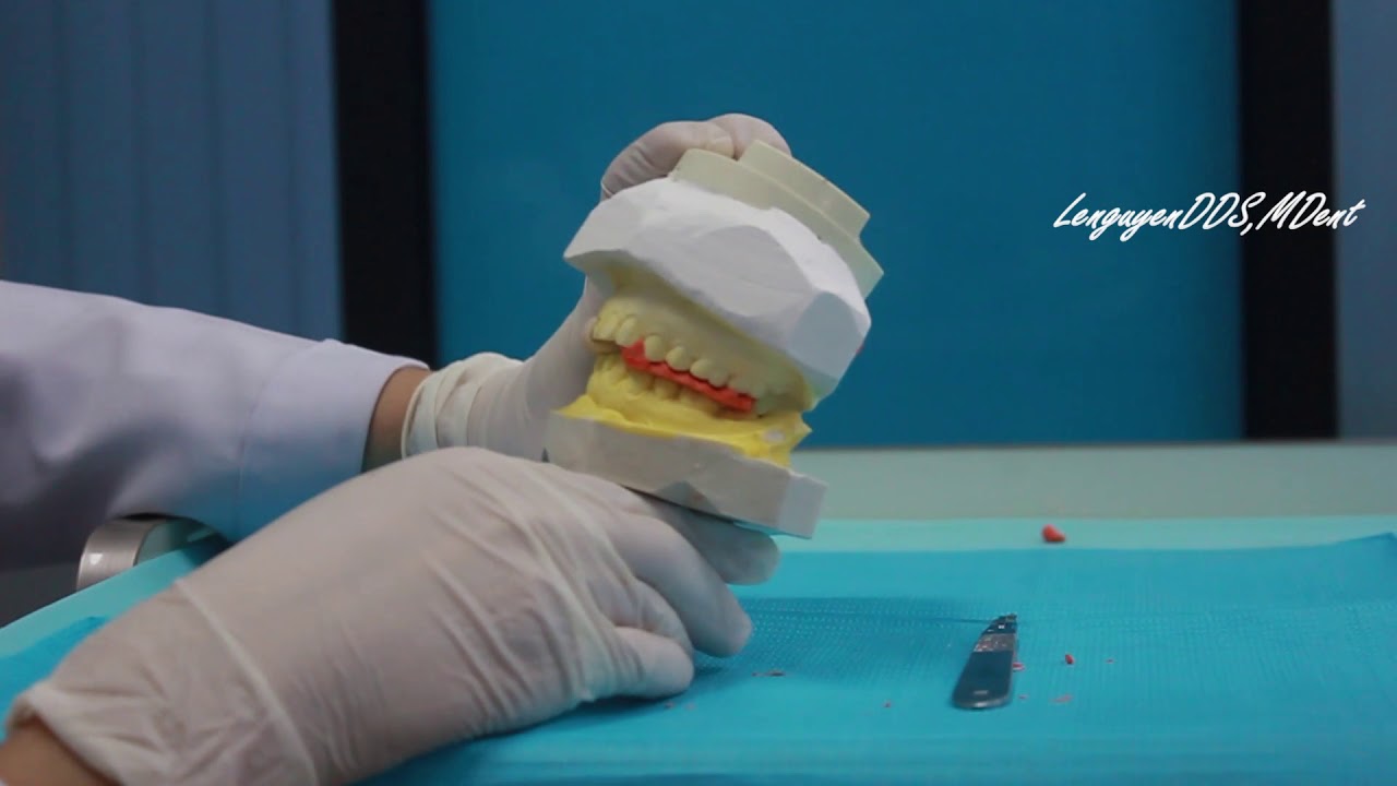 Centric relation record & mounting the lower cast - YouTube