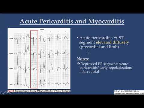 ST Elevasi But Not STEMI. High Troponin But Not ACS. Journal Reading 26 ...