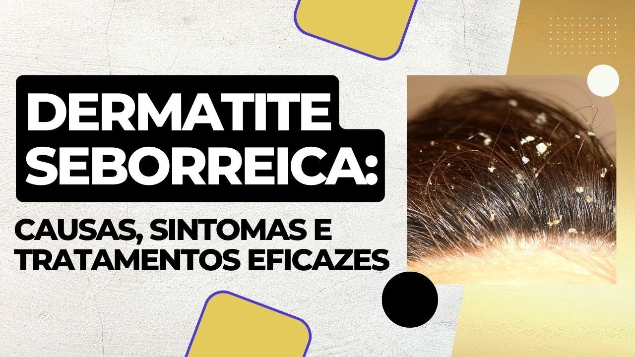 Dermatite Seborreica: Causas, Sintomas e Tratamentos Eficazes - YouTube