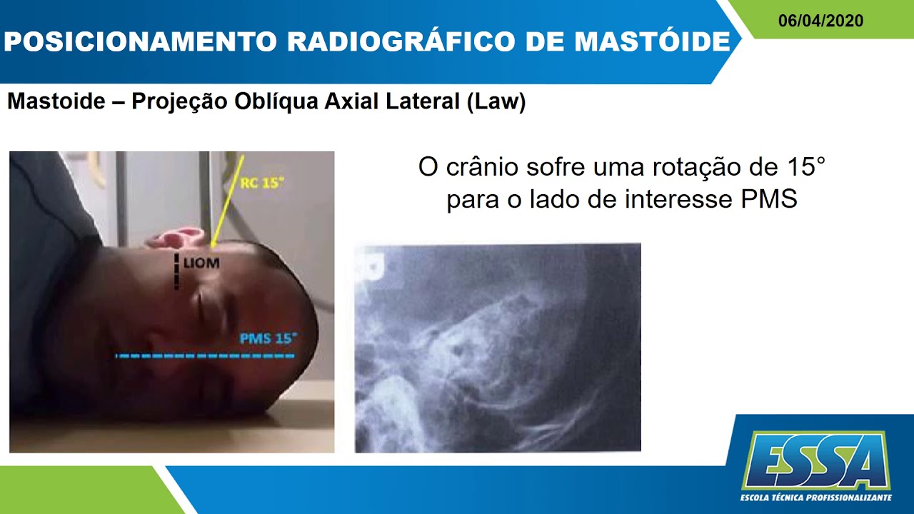 Procedimento Médico Para Mastoidite - RETOEDU