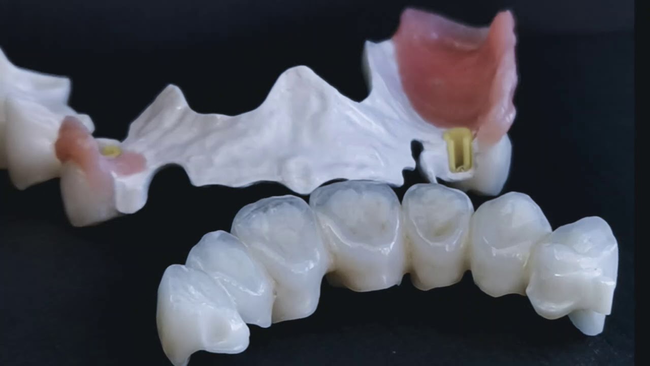 BioHPP Peek Removable Partial Denture Zirconia Frame E max Ceram biohpp-peek-removable-partial-denture-zirconia-frame-e-max-ceram