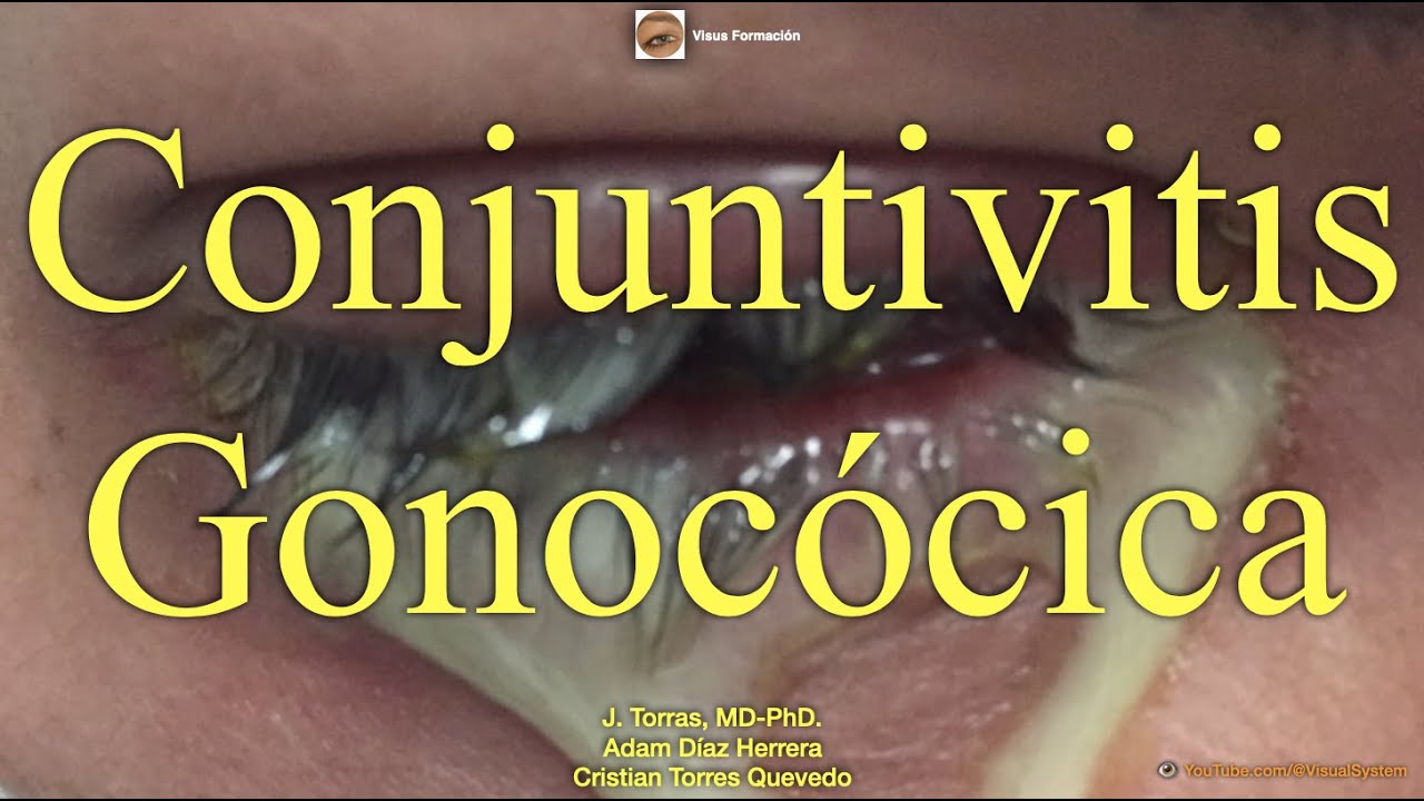 Conjuntivitis Gonocócica. - YouTube