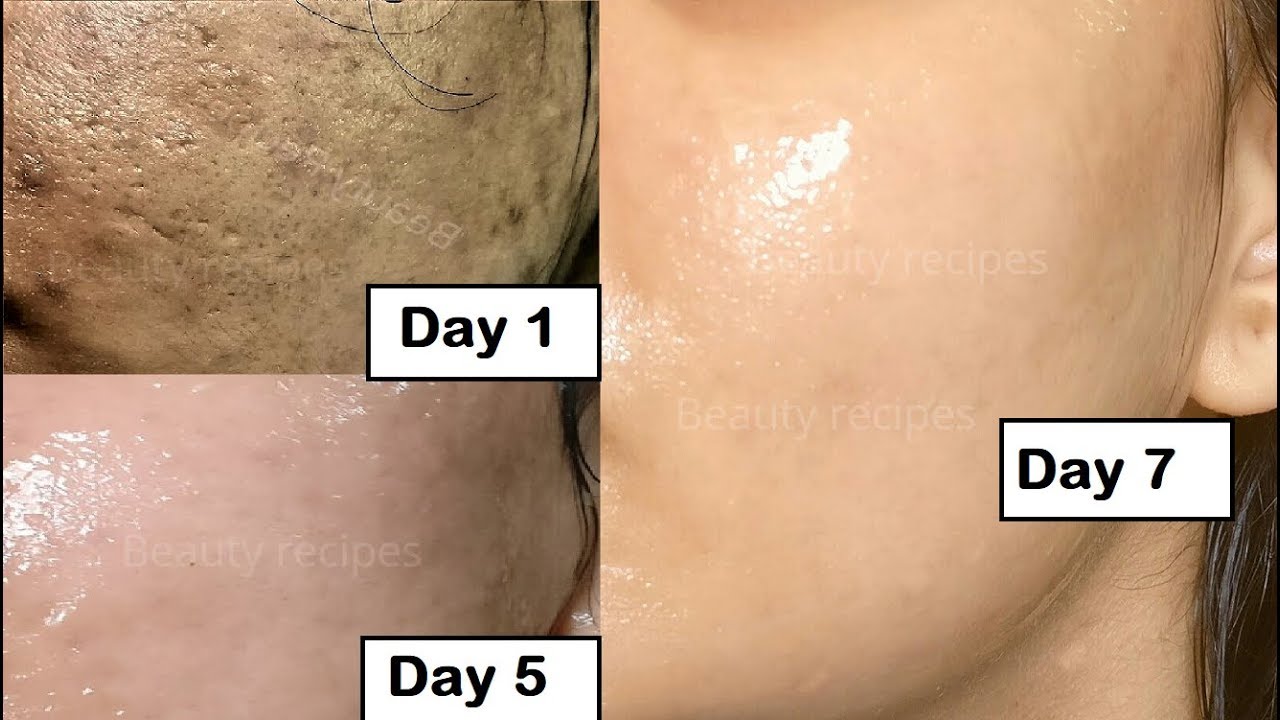 Skin Repair | Close Large OPEN PORES in 1 week, Remove Dark Spots, Anti ...