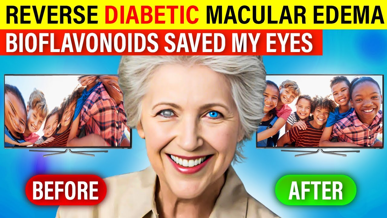 Top 3 Bioflavonoids That Will Save Your Vision After 50 Diabetic Macular Edema Youtube