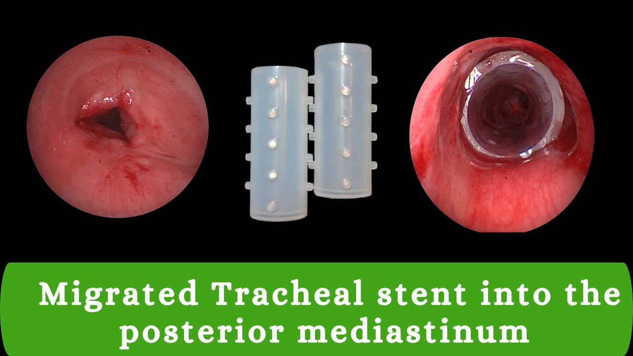 MIGRATED TRACHEAL SILICON STENT INTO THE POSTERIOR MEDIASTINUM - YouTube