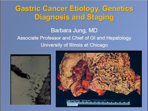 Gastric Cancer Etiology, Genetics, Diagnosis and Staging - YouTube