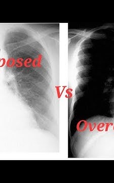 Underexposed Vs Overexposed CXR film !! Underexposed & Overexposed CXR को कैसे पहचाने?? - YouTube
