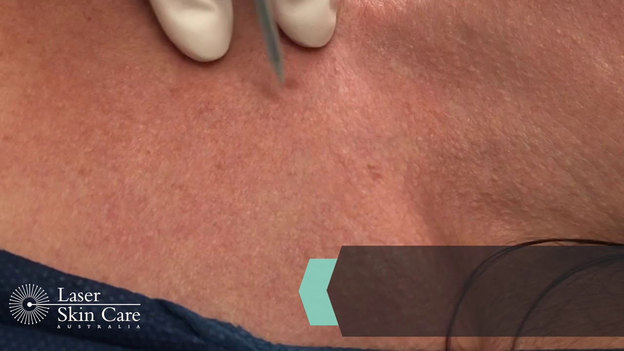 Benign Skin Spots, Lumps and Bumps - YouTube