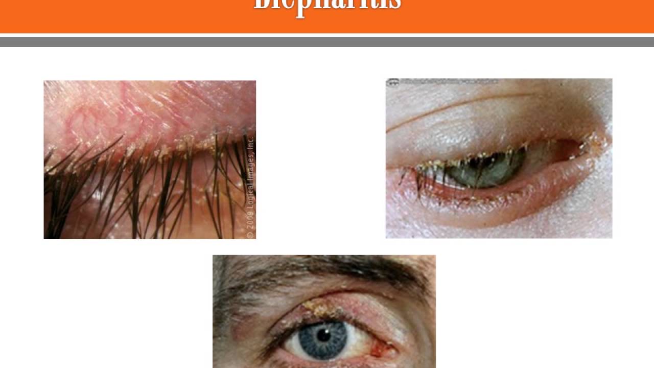 Ulcerative Blepharitis