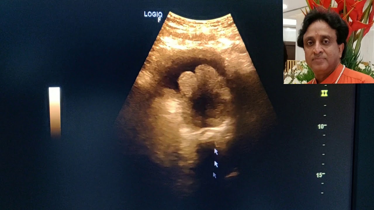 Benign Prostate Hyperplasia, Median Lobe Enlargement How to see Tricks ...