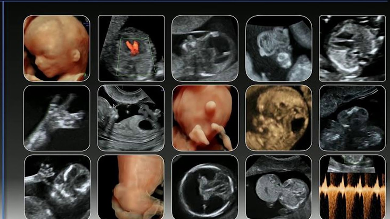 First trimester Early Anomaly Translucency Scan, NT Scan - YouTube