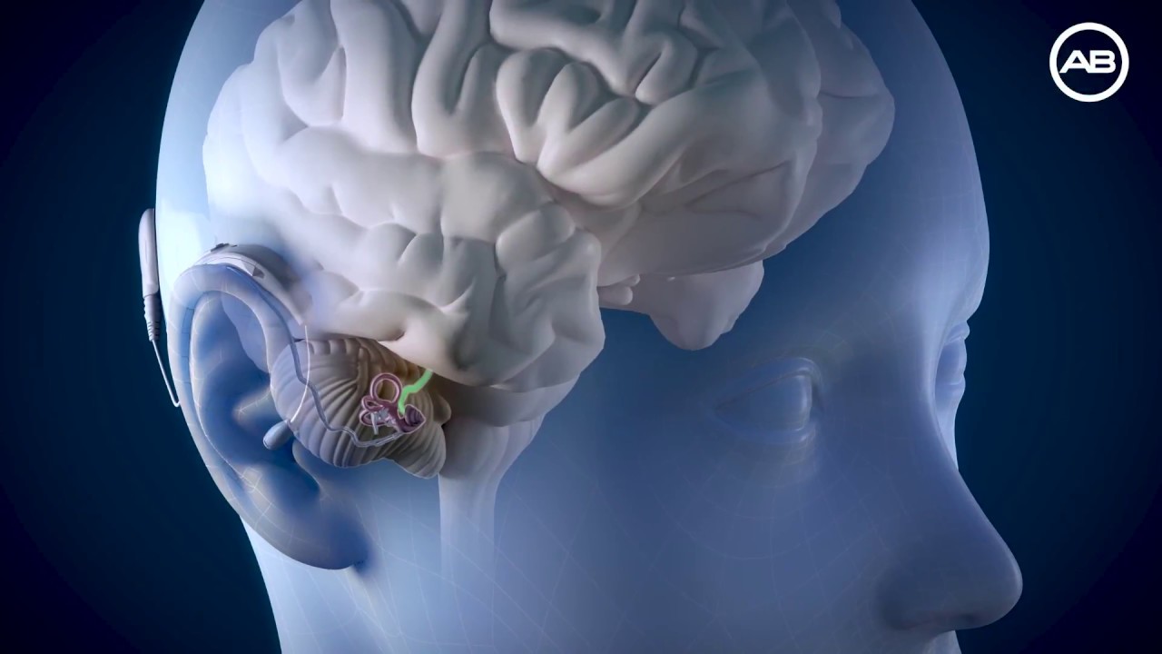 Implante coclear da Advanced Bionics - YouTube