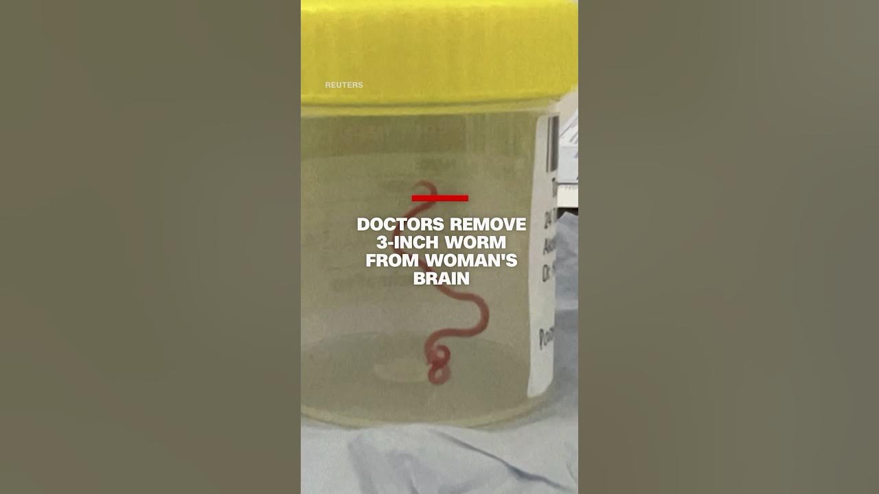 Worm removed from woman's brain - YouTube