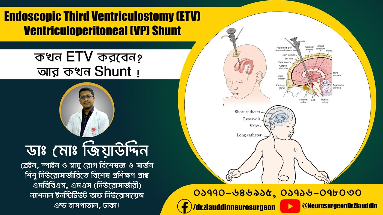 হাইড্রোক্যাফালাস বা মস্তিষ্কে পানি জমা। কখন ETV করবেন আর কখন Shunt ...