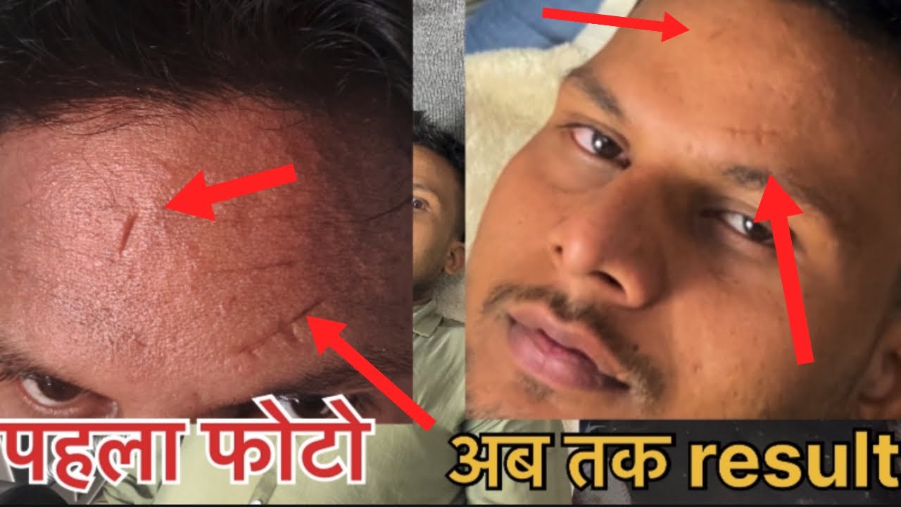 Forehead stitch mark result video,chot ke Nishan kese theek kare 🔥🔥 ...