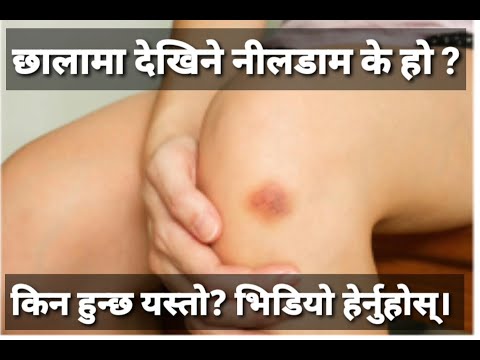 छालामा देखिने नीलडाम के हो ? थाहा पाईराख्नुहोस् ।