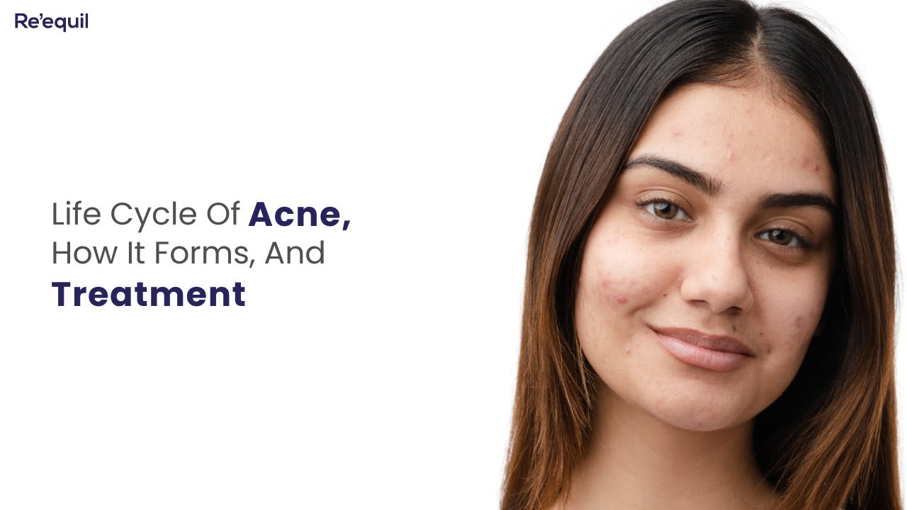 Life Cycle Of Acne, How It Forms, And Treatment - YouTube