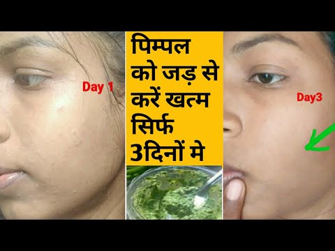 World Best Remedy For Pimple Treat Your Skin At Home/How to remove ...