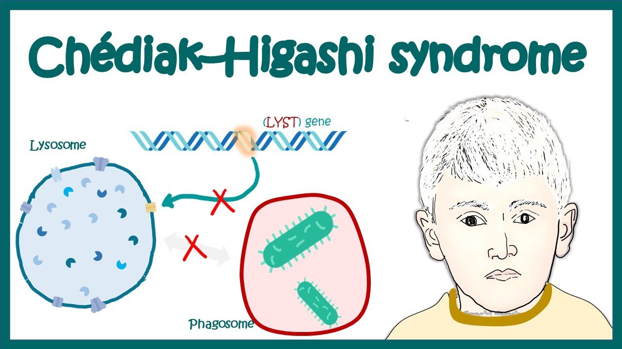 chediak higashi syndrome | What are the symptoms of Chediak Higashi ...