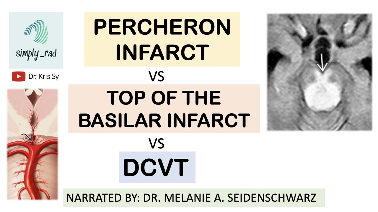 Percheron art infarct VS top of the basilar VS venous thrombosis - YouTube