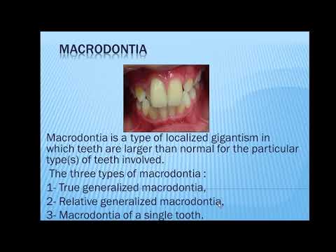38-Types of macrodontia - YouTube