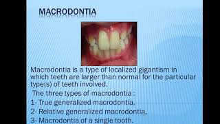Macrodontia