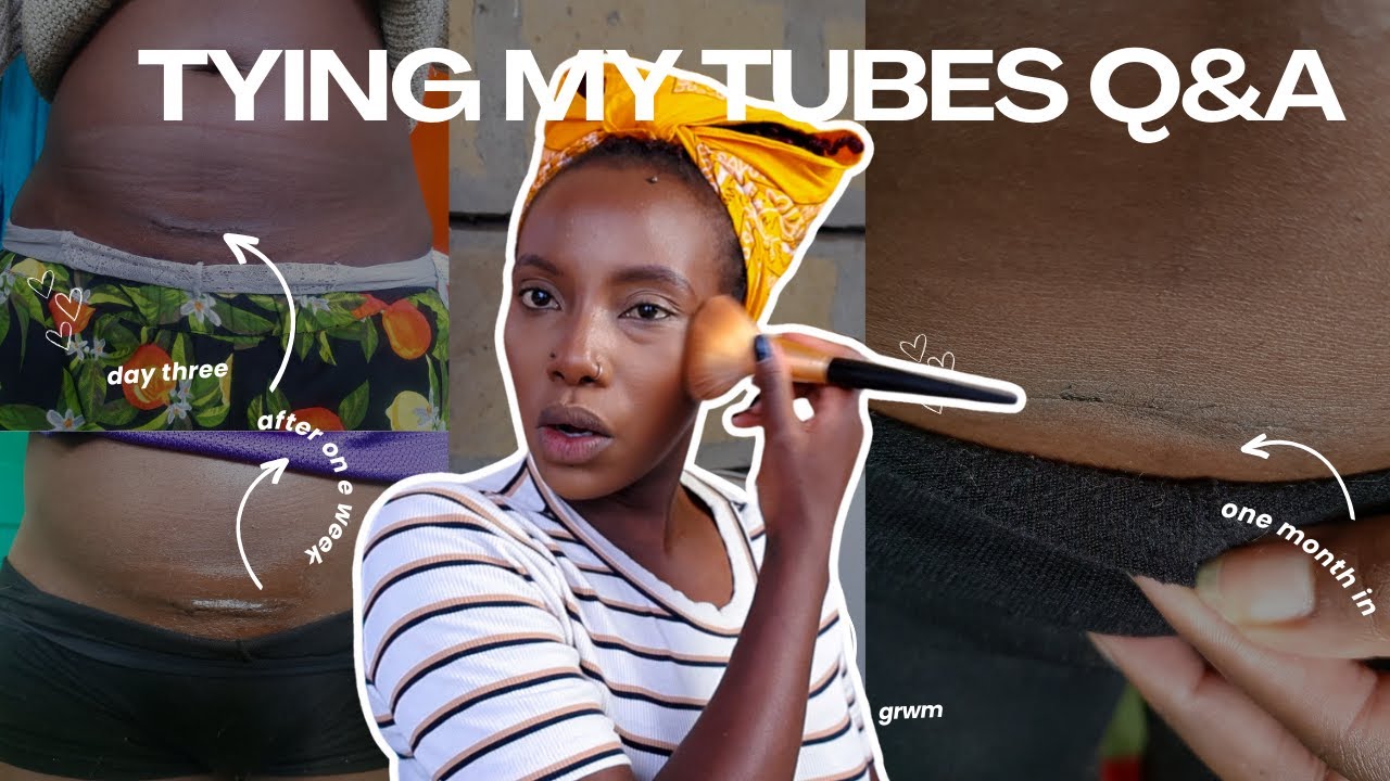 GRWM: Tubal Ligation Q & A | side effects, recovery, pain, regrets ...