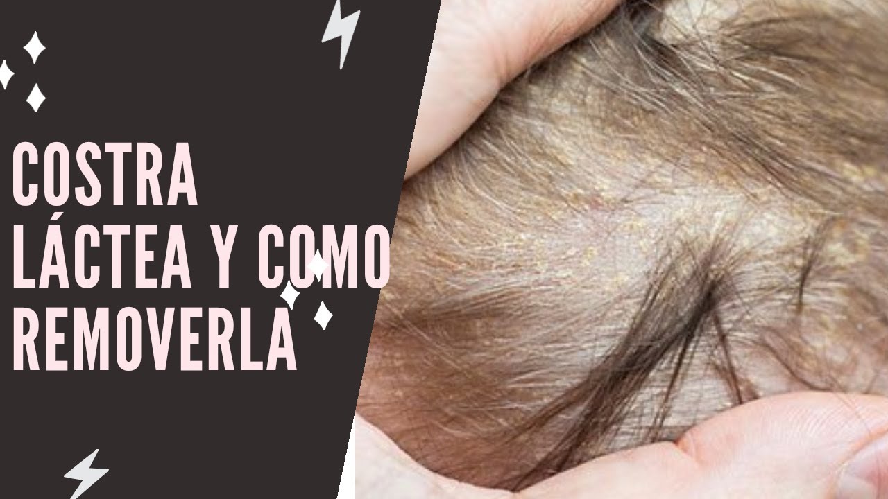 ¿Cómo quitar la caspa de bebé? | New mom - YouTube