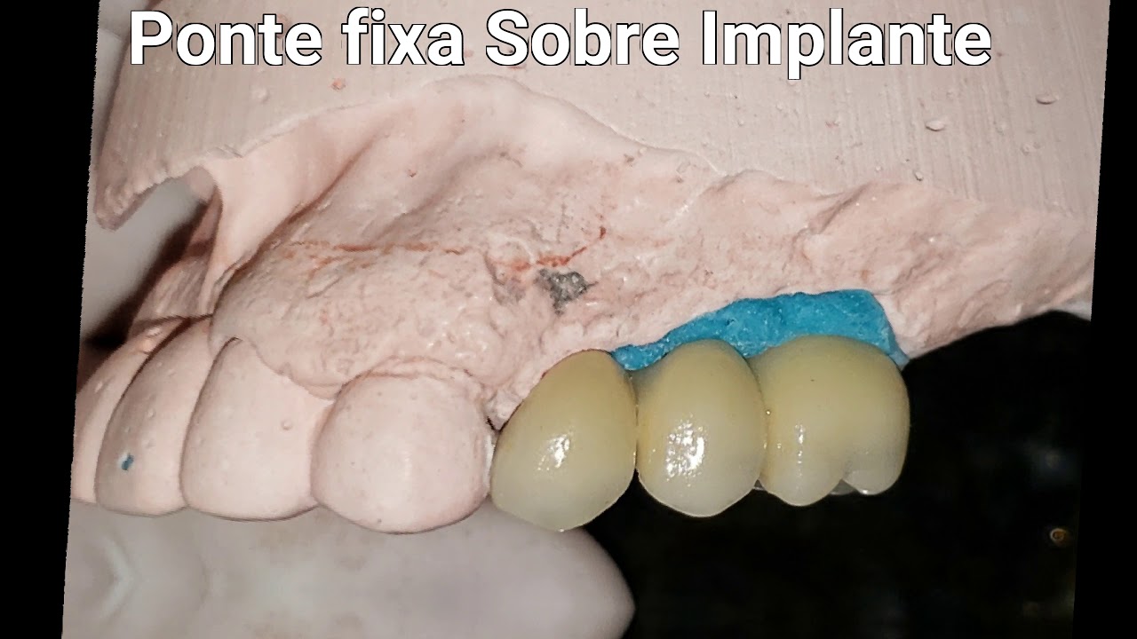 Ponte fixa Sobre Implante aparafusado - YouTube