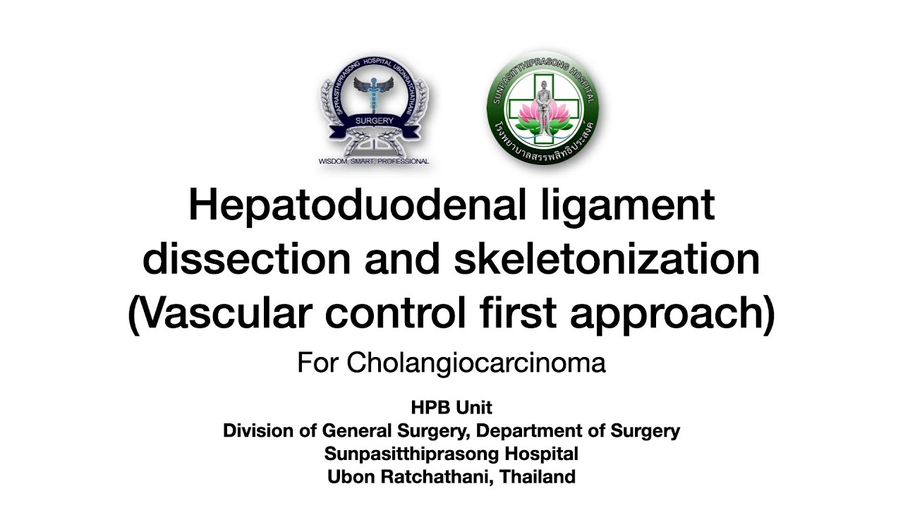 Hepatoduodenal ligament dissection and skeletonization for CCA ...