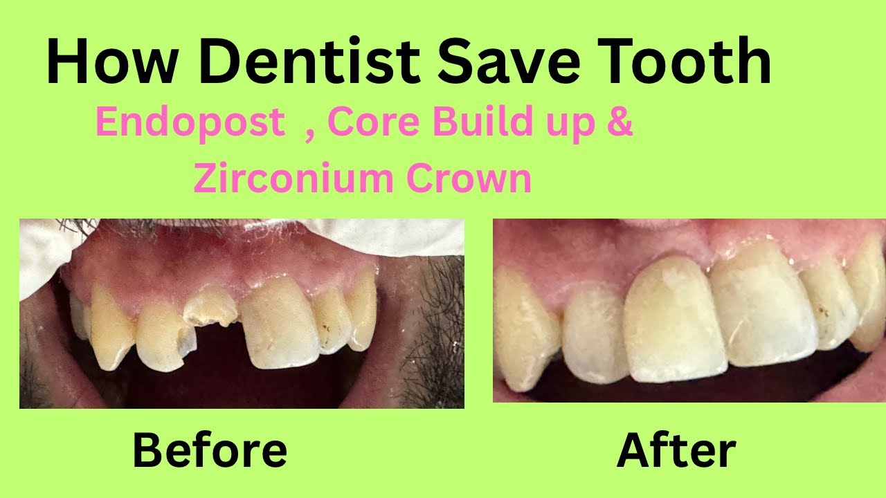 How Dentist Save Badly Broken Down Tooth | Endopost , Core Build up ...