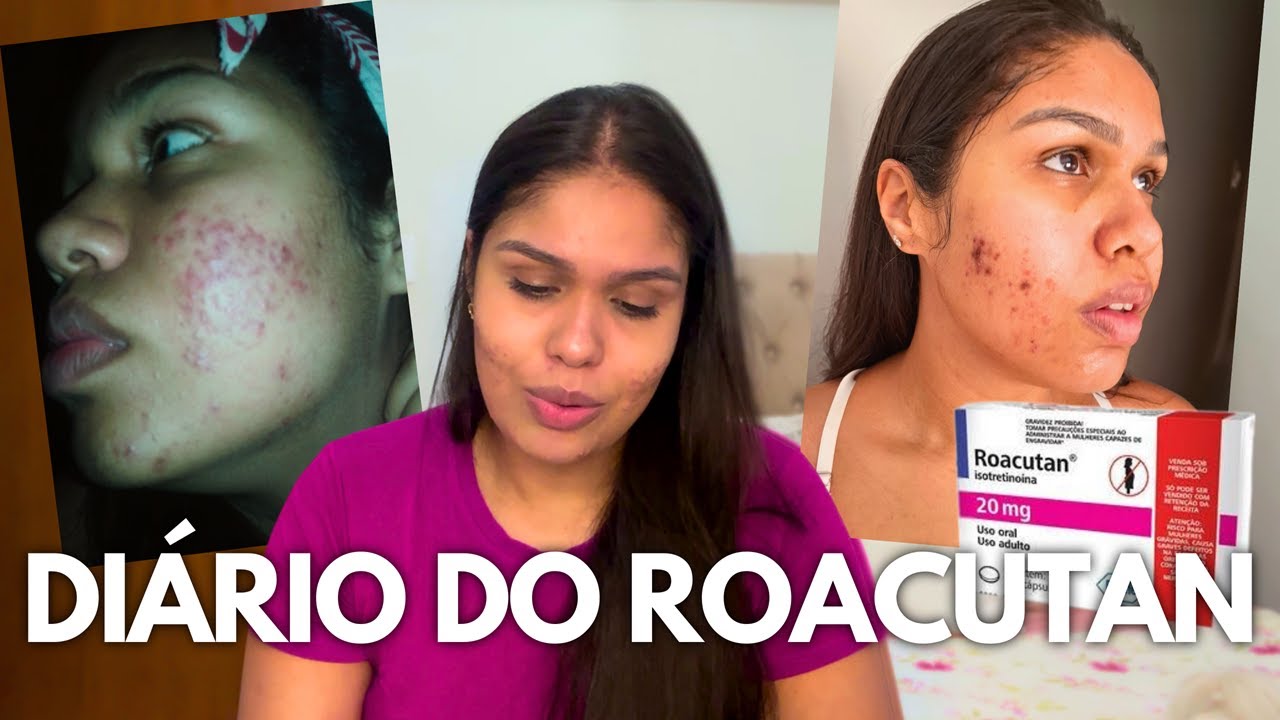 INICIEI O TRATAMENTO COM O ROACUTAN: MINHA HISTÓRIA COM A ACNE E COMO ...