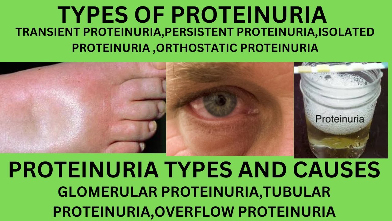 Types of proteinuria. Orthostatic proteinuria, Isolated Proteinuria ...