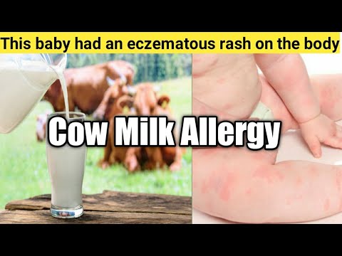 Treatment of 🐄 Cow Milk Protein Allergy in Infants | A complete guide ...