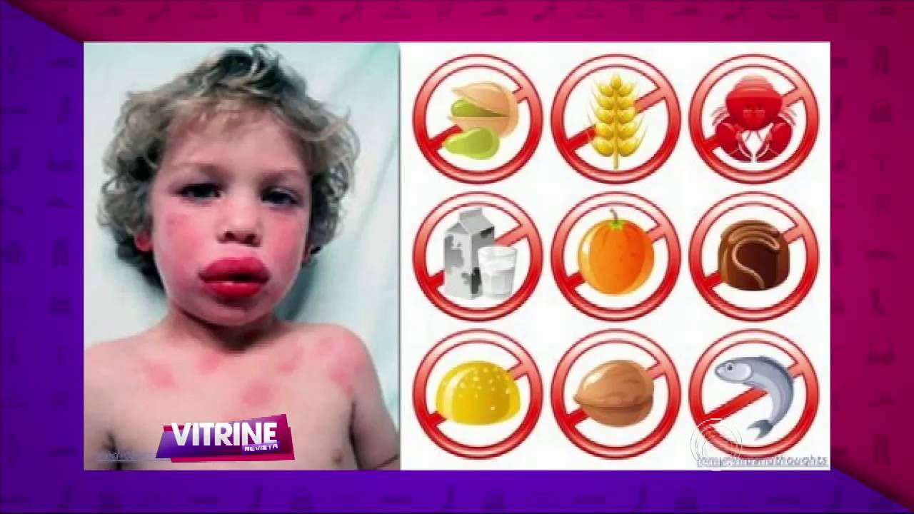 Nutricionista fala sobre alergia alimentar e intolerância alimentar ...