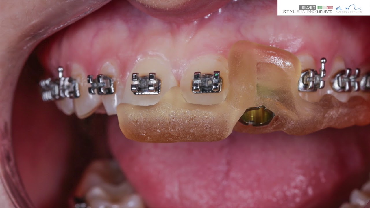 Surgical guide design with Trios Implant Studio and procedure with ...