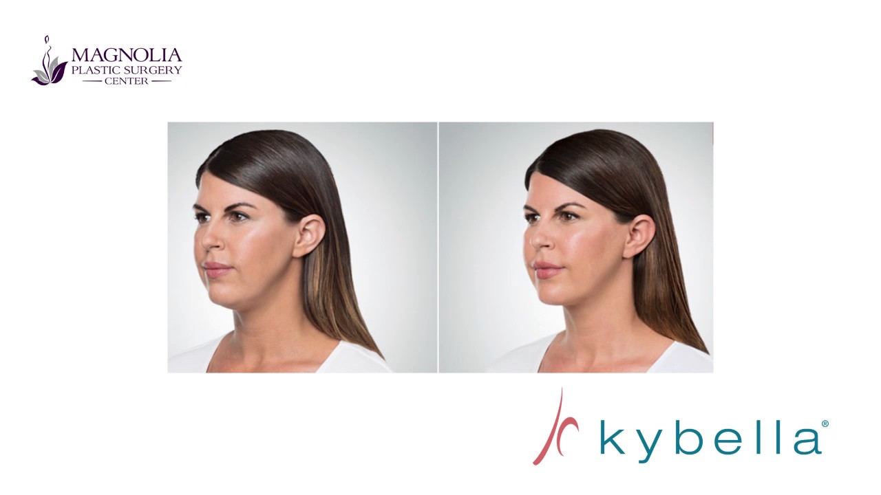 Kybella Before And After Gallery - Double Chin Treatment in Tampa and ...