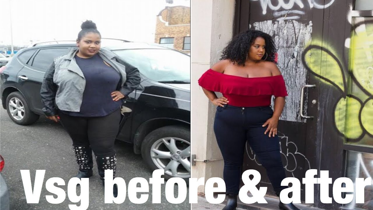VSG QUESTION ANSWERED/ Before & After pics - YouTube