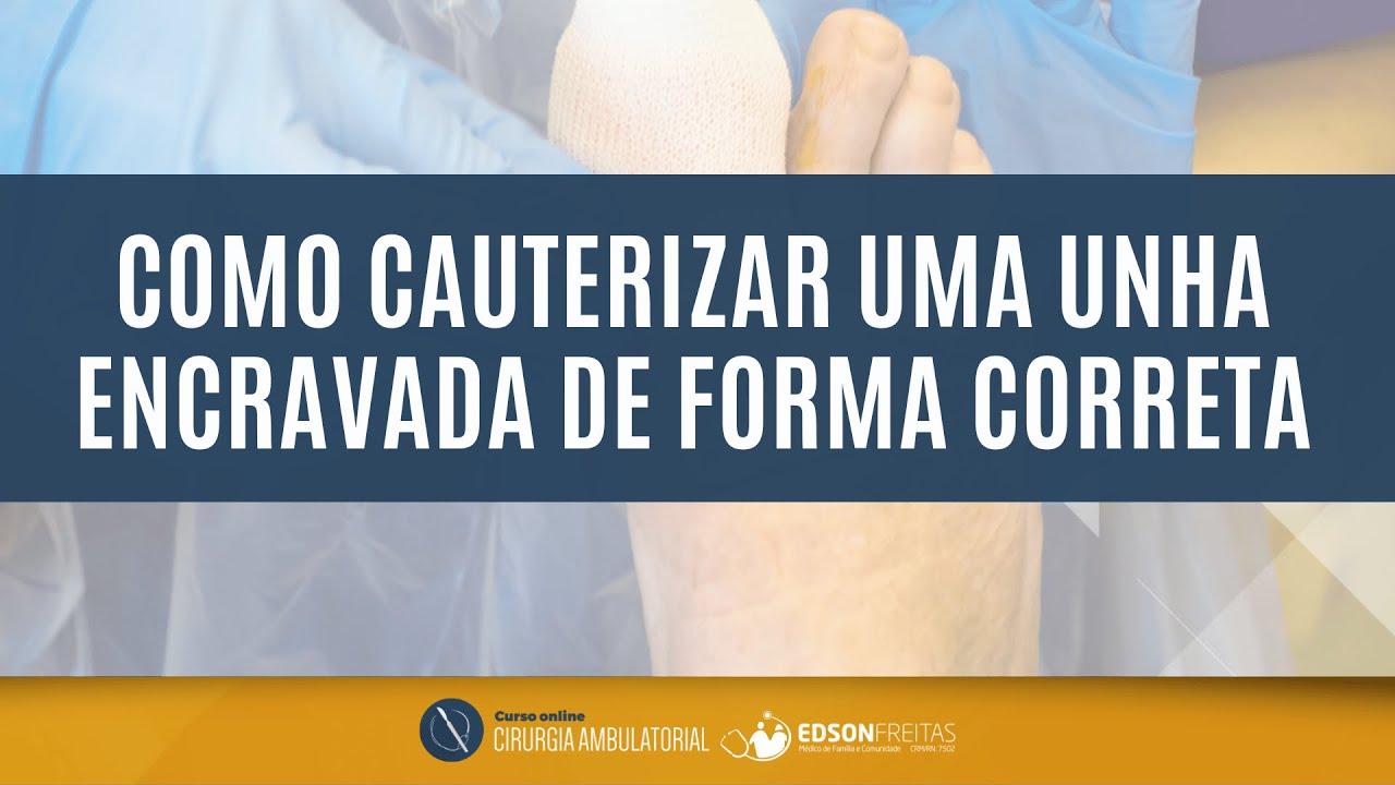 Como cauterizar uma unha encravada de forma correta - YouTube