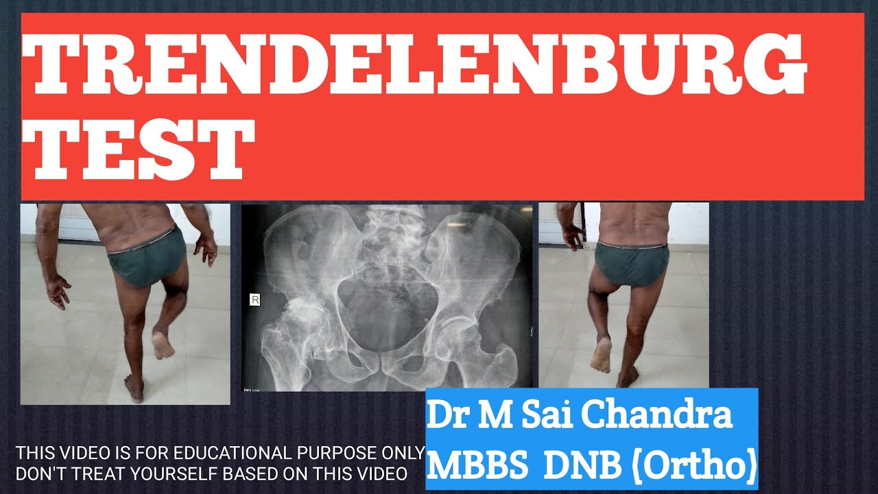 Trendelenburg Test Demonstration - YouTube