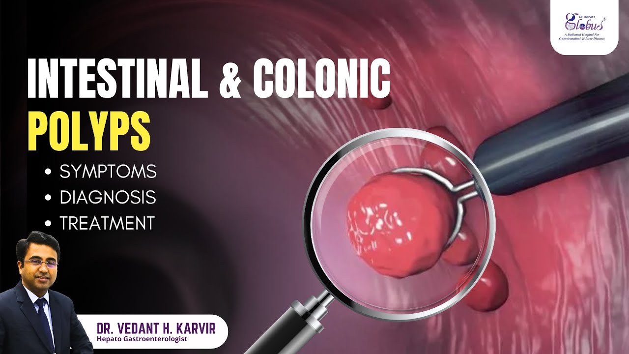 Colon के अंदर Polyp : Symptoms, Diagnosis, Treatment | Blood in Stool ...