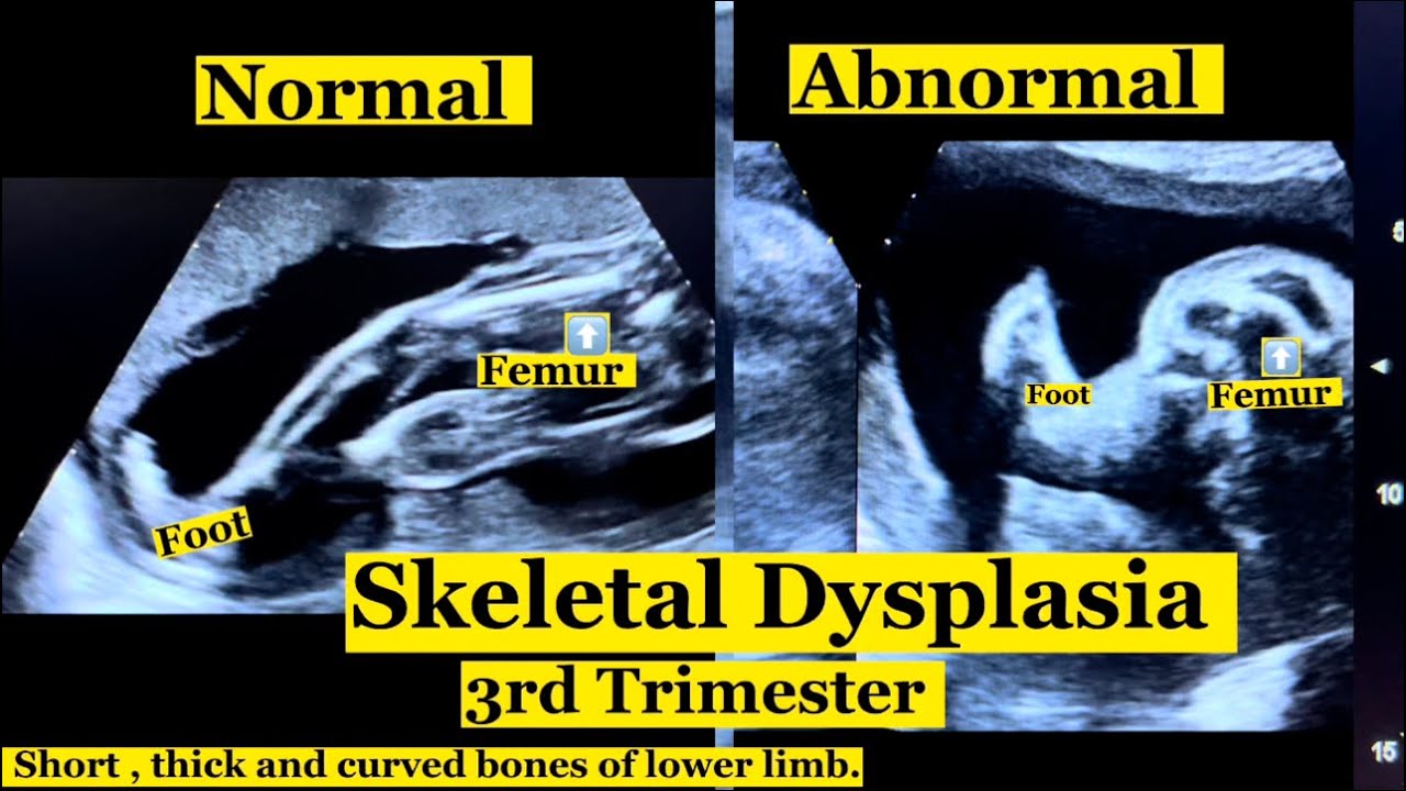 Fetal Ultrasound Skeletal Dysplasia – ITZNS