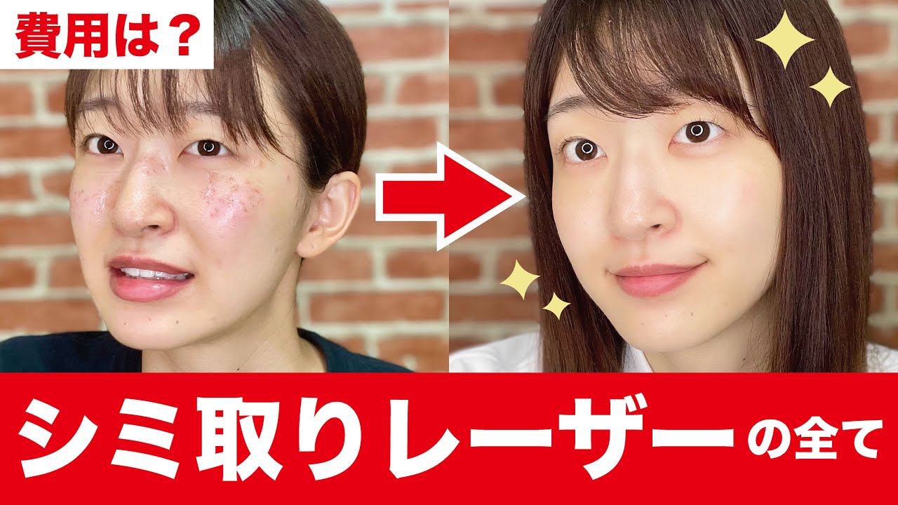【シミ取りレーザー】費用や経過、治療前に知っておいた方がいいこと。そばかすの姫。 Youtube