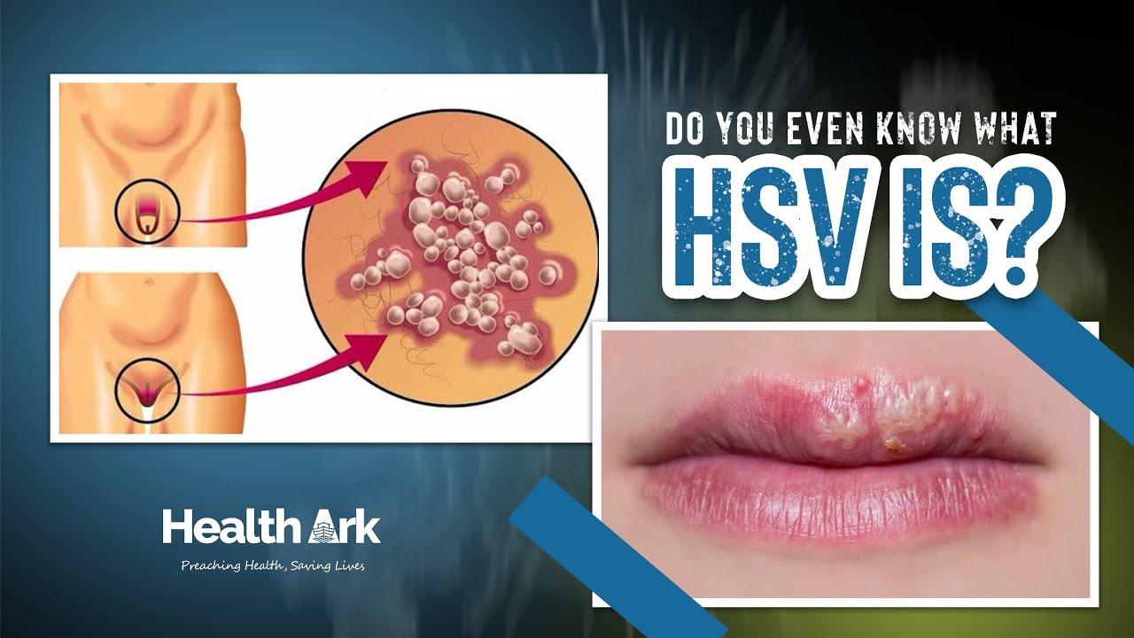 Introduction to HSV(Herpes Simplex virus): Understanding Herpes Simplex virus. - YouTube