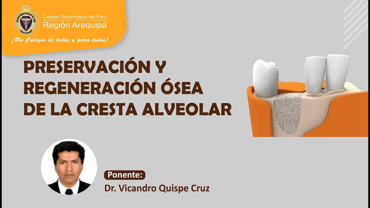 PRESERVACIÓN Y REGENERACIÓN ÓSEA DE LA CRESTA ALVEOLAR - YouTube