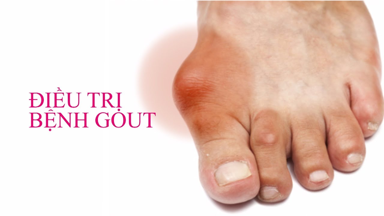 Bệnh gout và cách điều trị Gout - YouTube