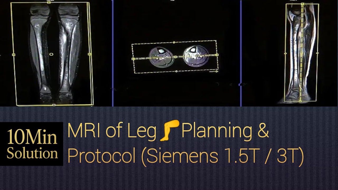 How to MRI of Leg Planning SIEMENS 1.5 T 3T MRA lower limbs planning ...