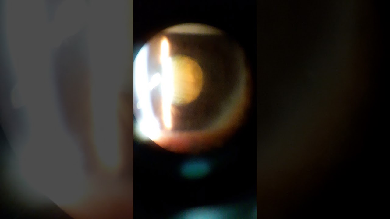 Hyperoleon (inverted hypopyon) (emulsification of silicon oil) - YouTube