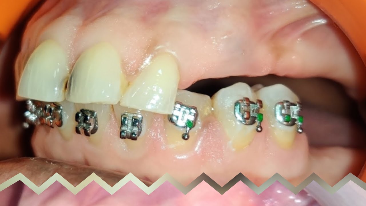 Preprosthetic orthodontics with intrusion of premolars in a 65 year old ...