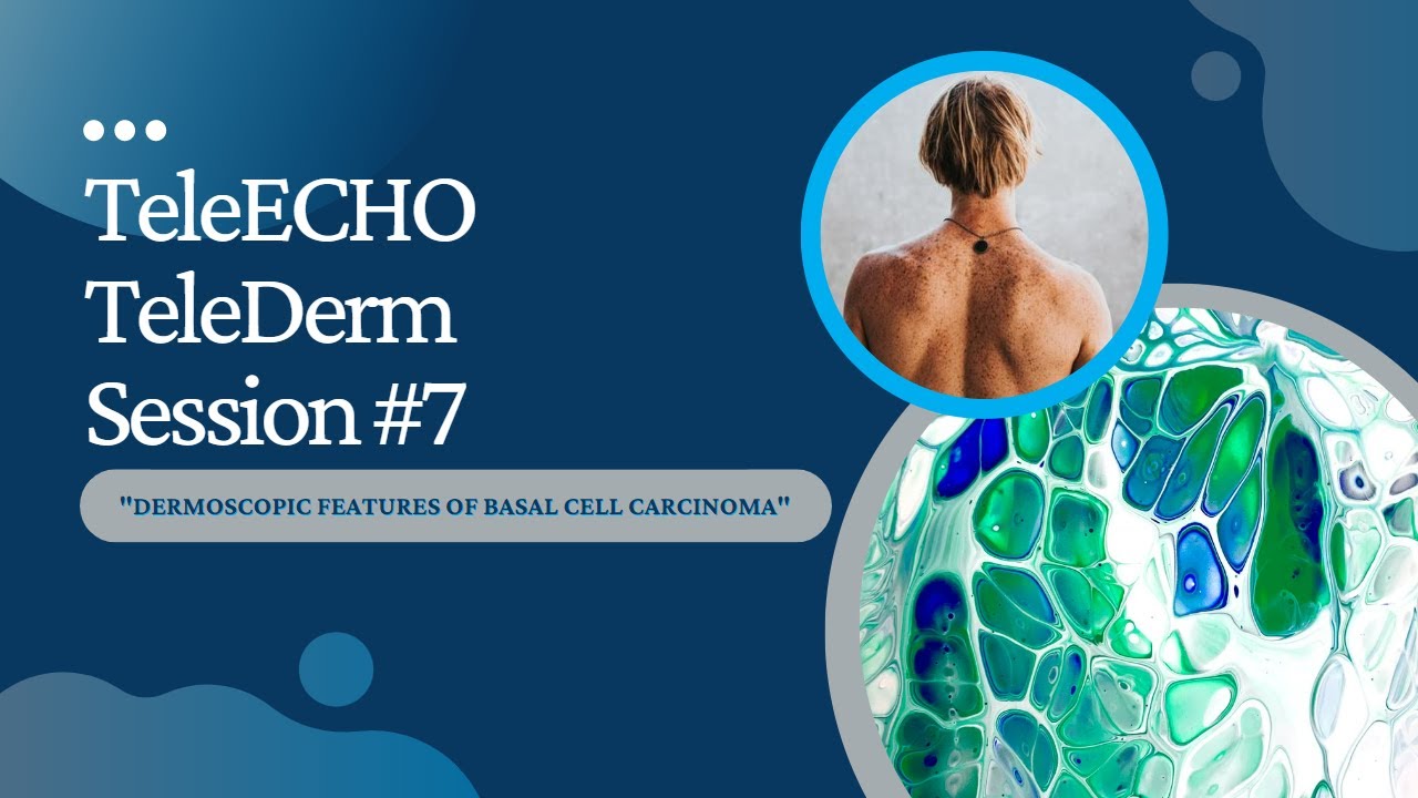 TeleECHO TeleDerm Session #7 - "Dermoscopic Features of Basal Cell ...